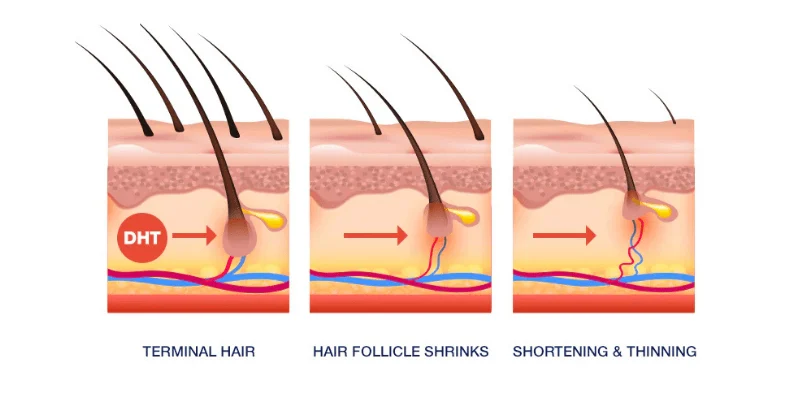 Hair Fall Causes in Men | Hair Revive Hub